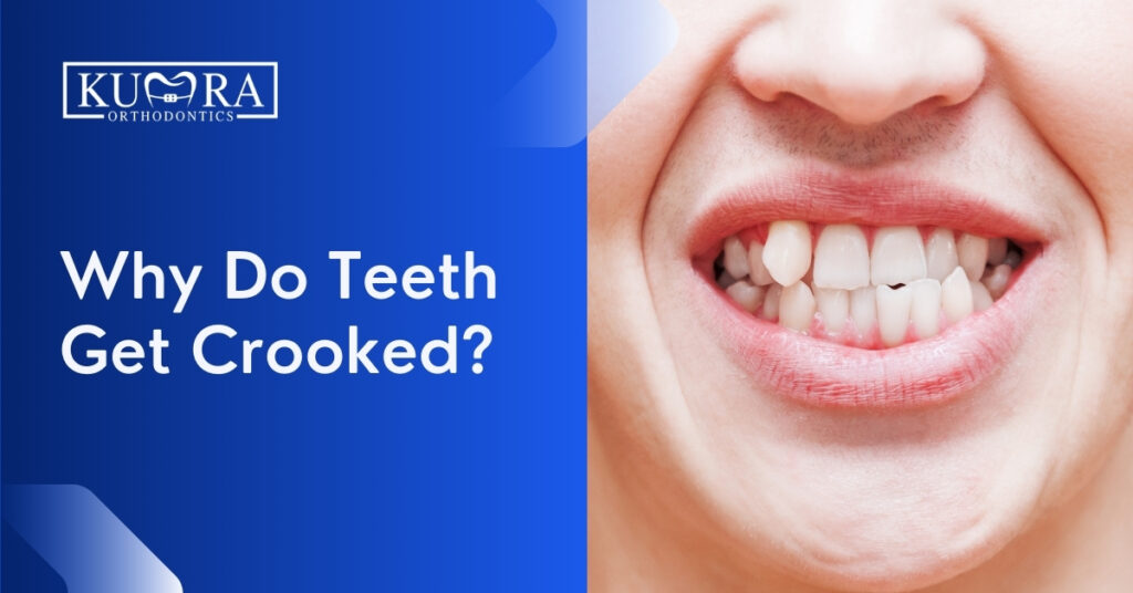Why Do Teeth Get Crooked? | Kumra Orthodontics