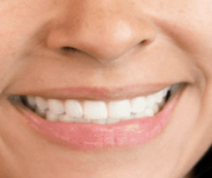 Invisalign® in Washington DC | Kumra Orthodontics