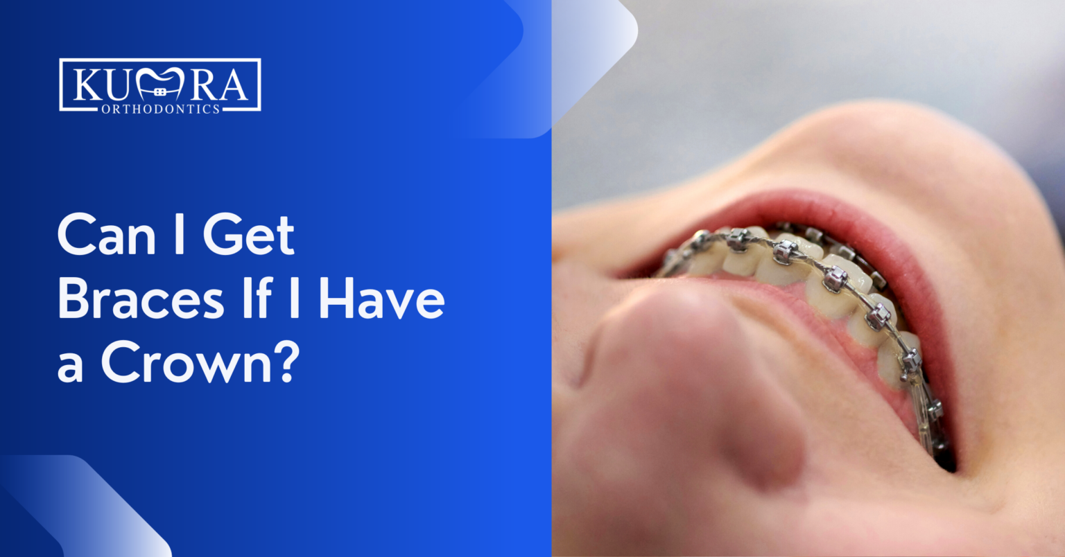 Can You Get Braces with a Crown? Things to Know | Kumra Orthodontics