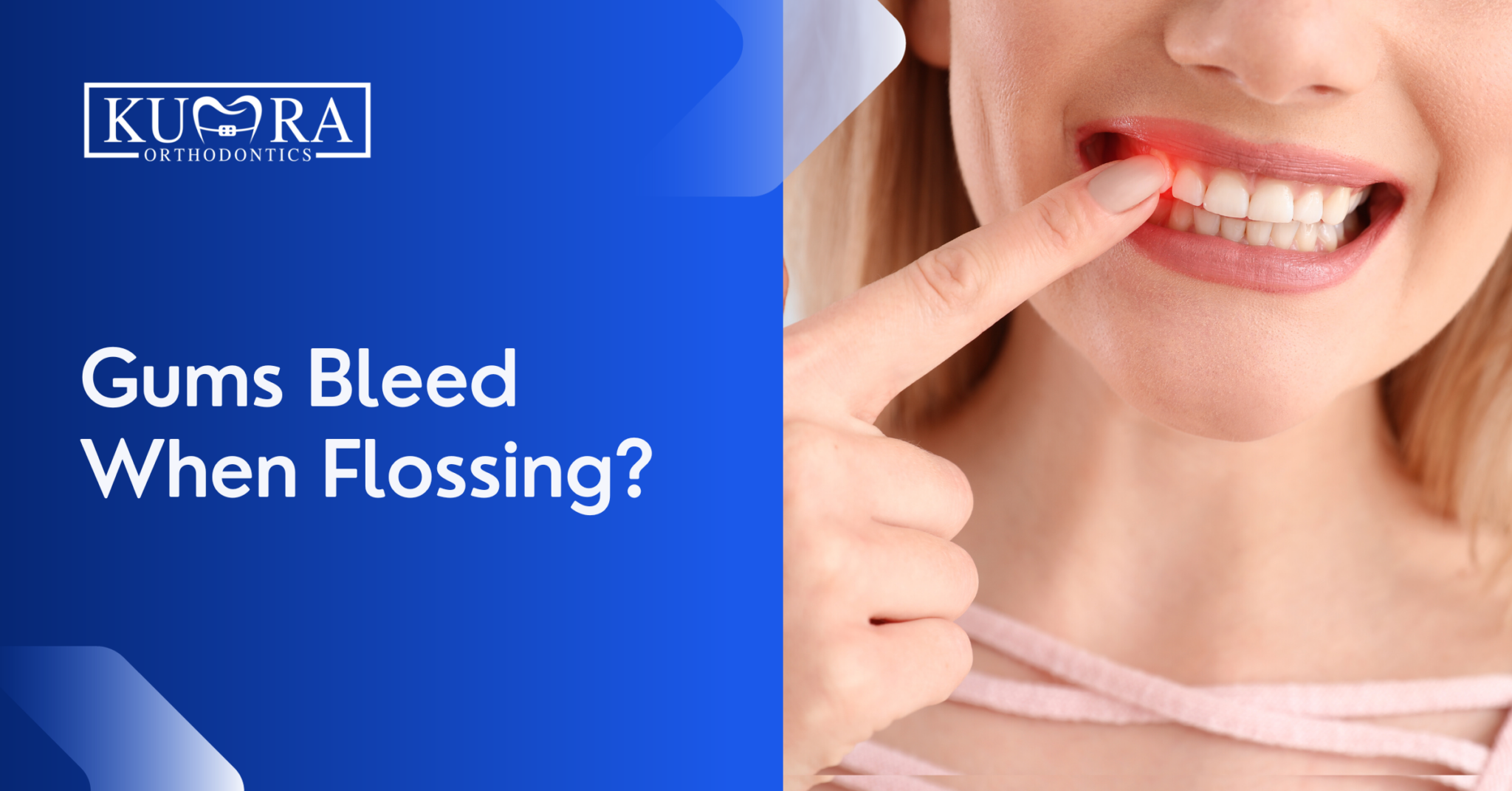Why Gums Bleed When Flossing: Causes and Remedies | Kumra Orthodontics