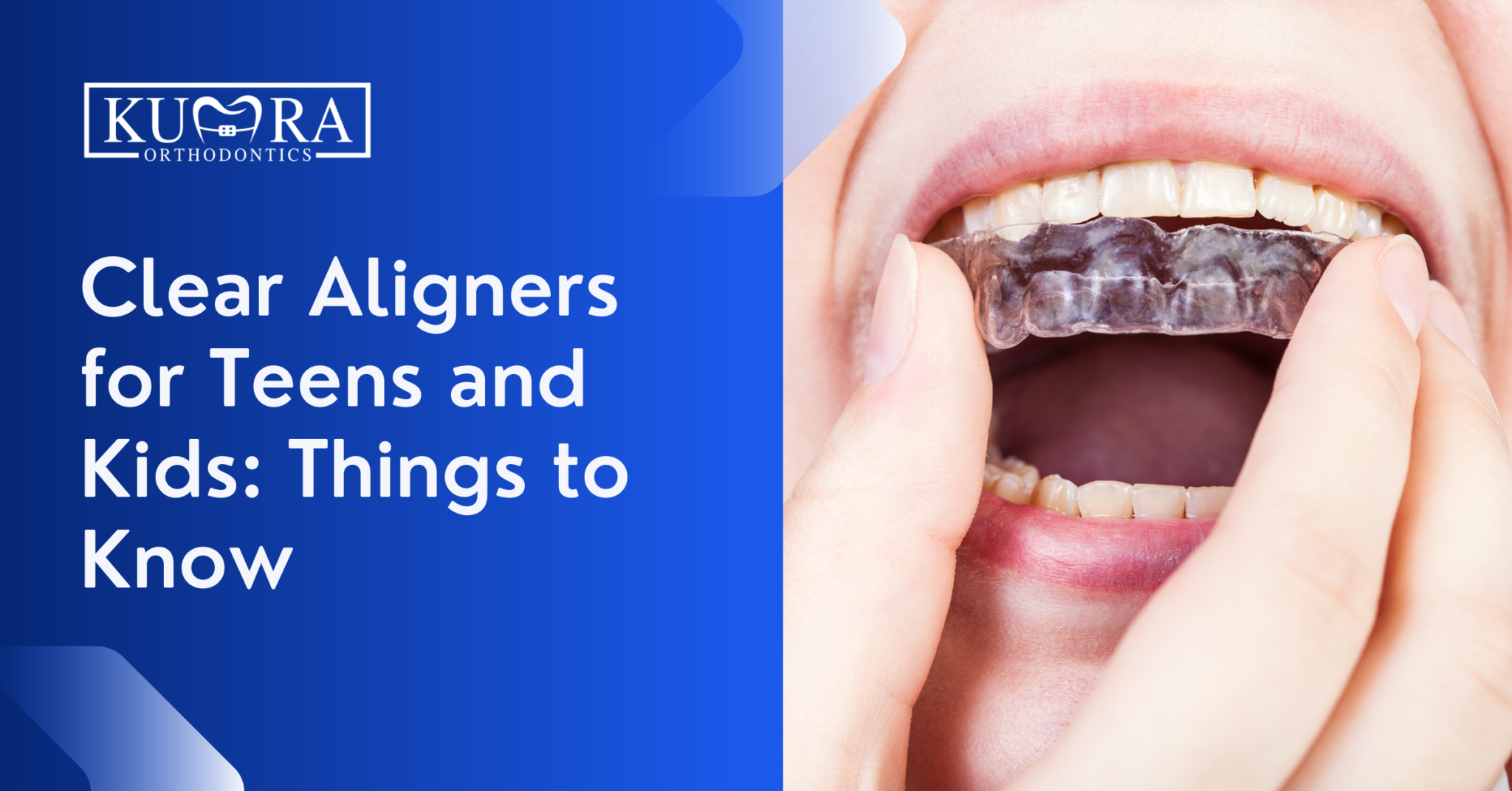 Clear Aligners for Teens and Kids: Things to Know | Kumra Orthodontics